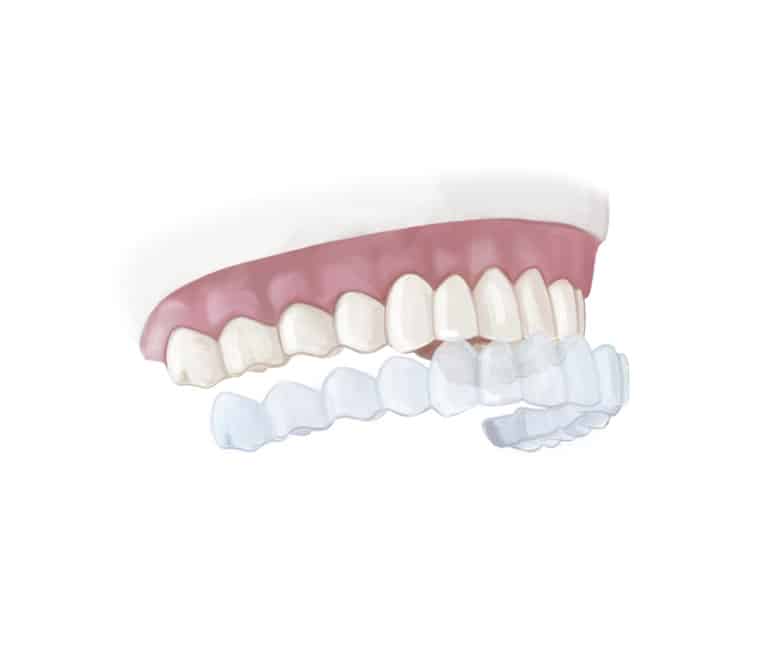 ClearCorrect™ Clear Braces | Austin, Tx